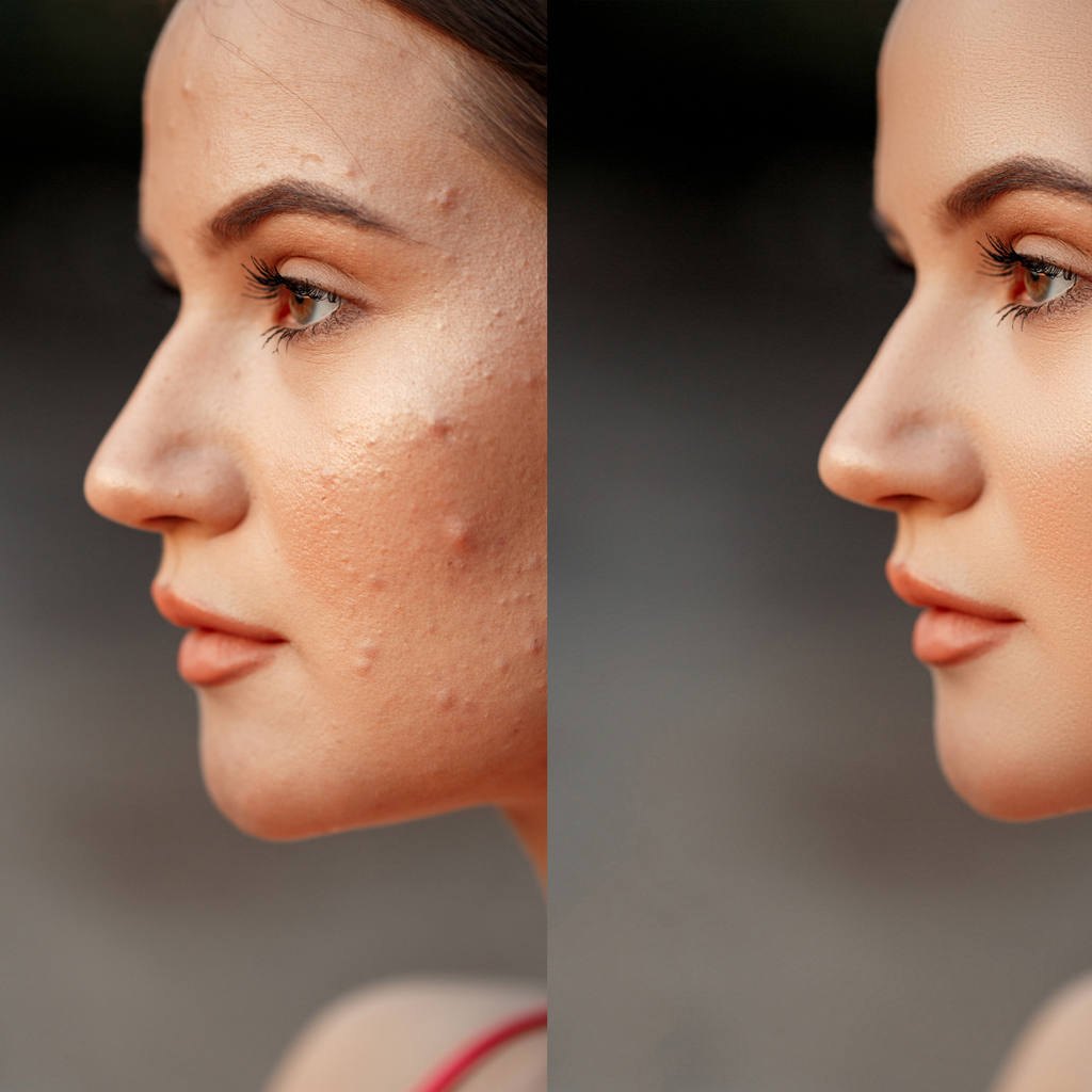 A Breakthrough Solution for Acne-Prone Skin – Bella Aura Skincare