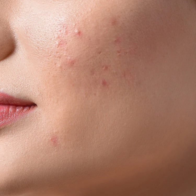 Micro Silver: The Ingredient That Solves Acne, Rosacea, Itchiness, and ...